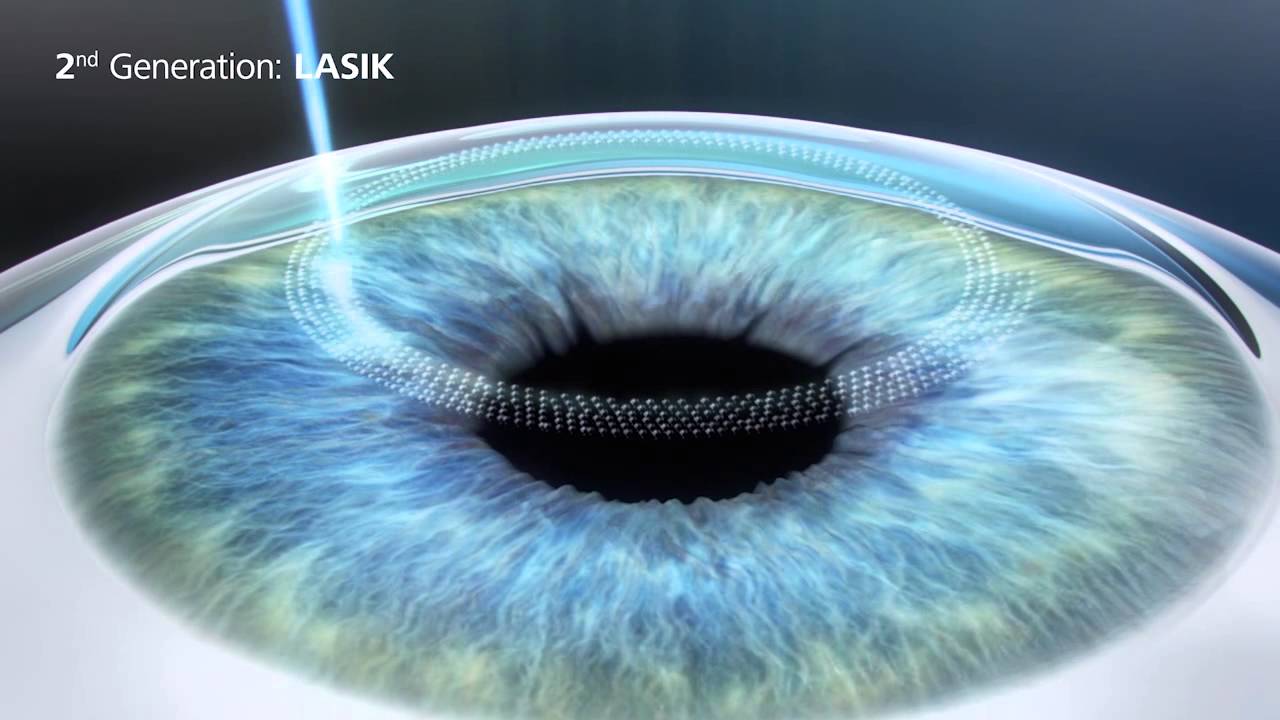 The ReLEx SMILE Procedure - YouTube