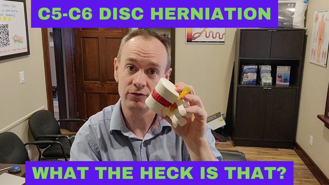 What Is A C5-C6 Disc Herniation? C5-C6 DISC BULGE | Causes, Symptoms ...