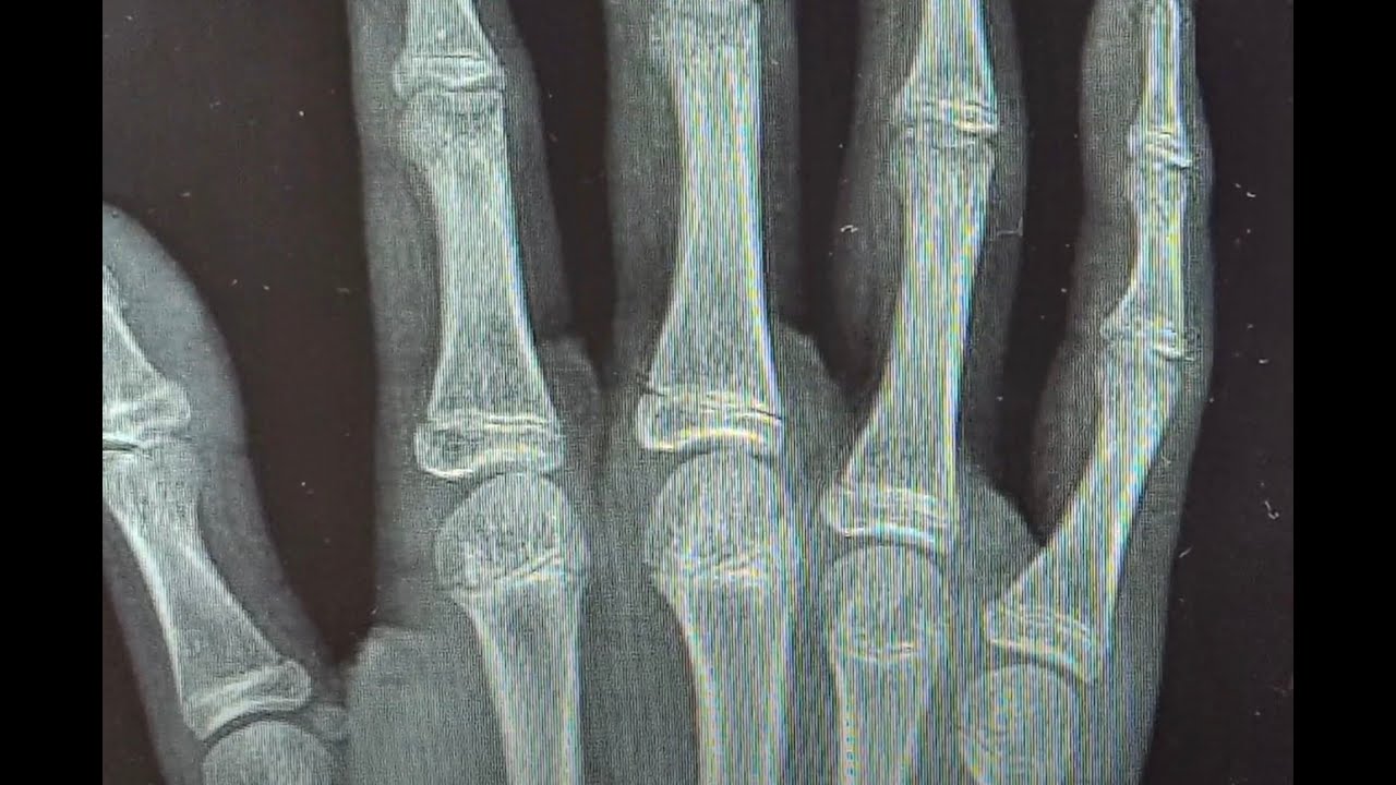 My First Broken Bone - YouTube