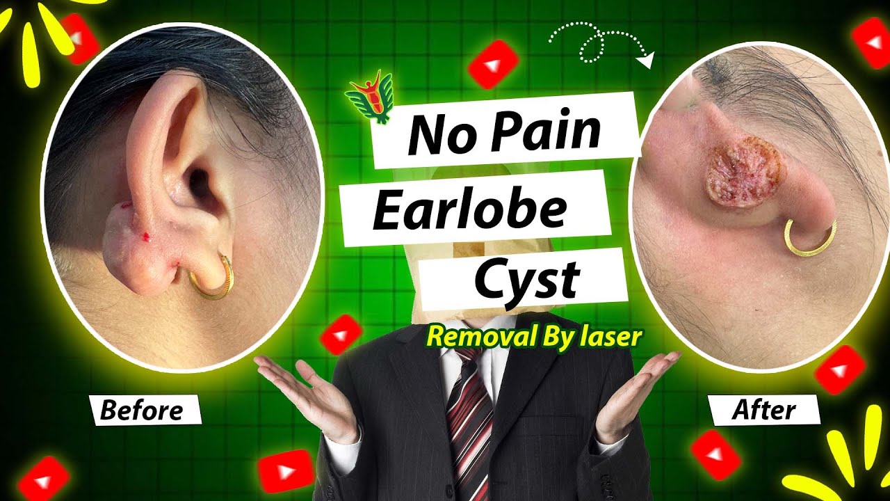 Laser Treatment for Earlobe Cyst | Quick & Effective Remova| Dr.Sanjeeb ...