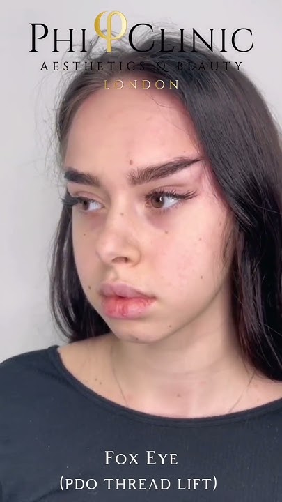 Fox Eye (PDO Threads Lift) - YouTube