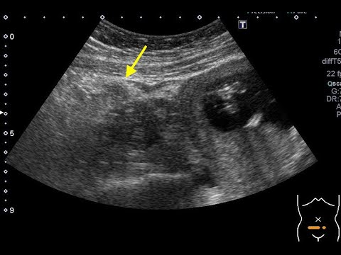 appendicitis in pregnant women - YouTube