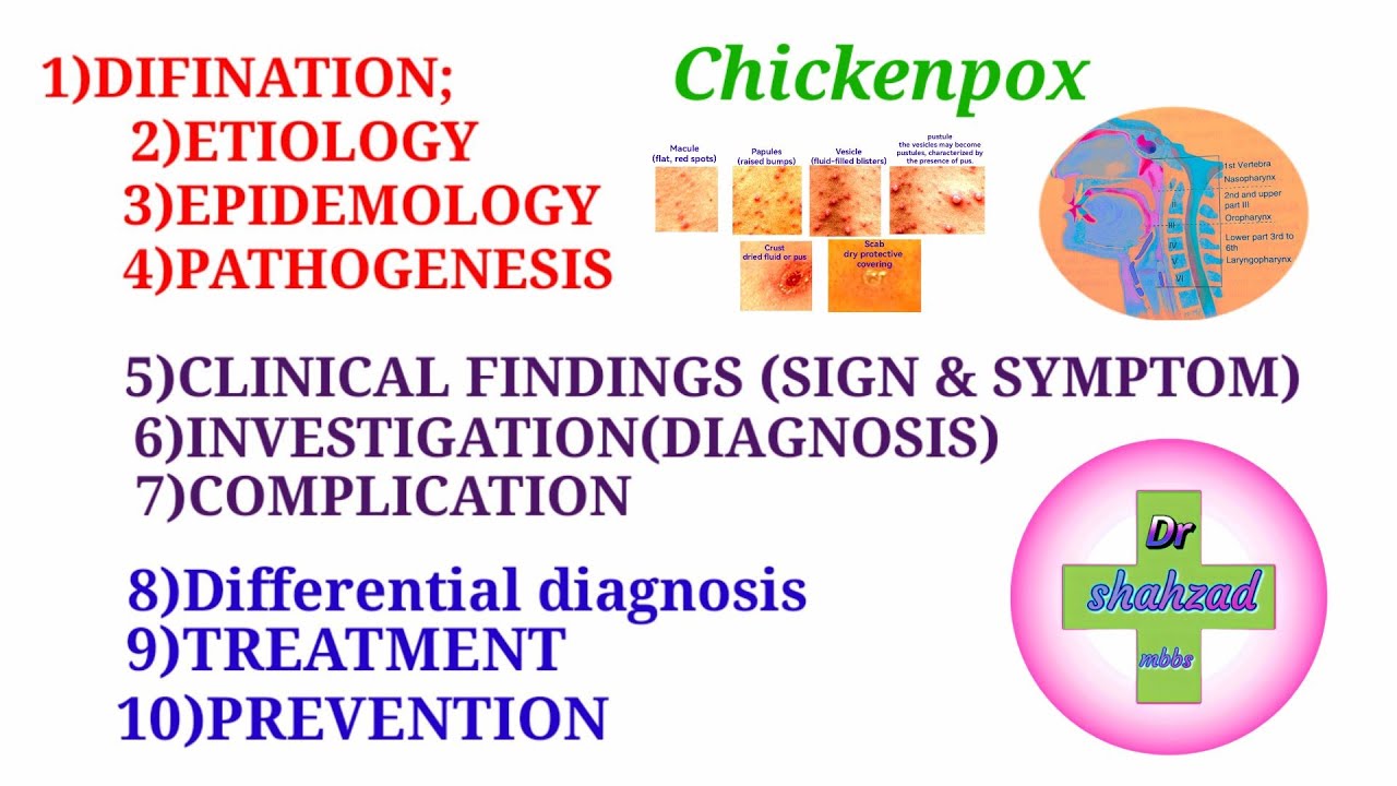 Chickenpox / chicken pox / shingles / etiology,epidemiology,symptom ...