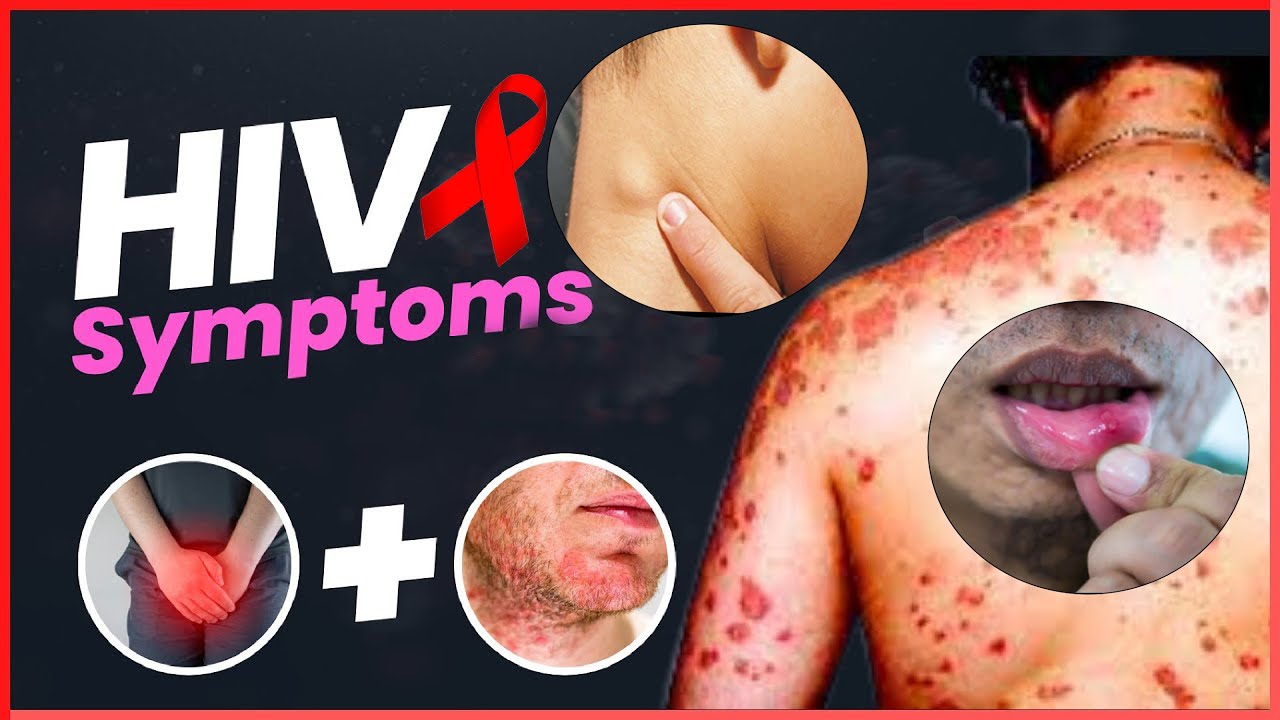 Early Signs of HIV AIDS in Men and Women | HIV Positive Signs - YouTube
