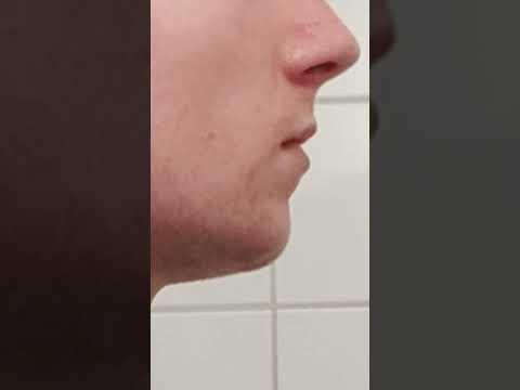 Receding chin fix