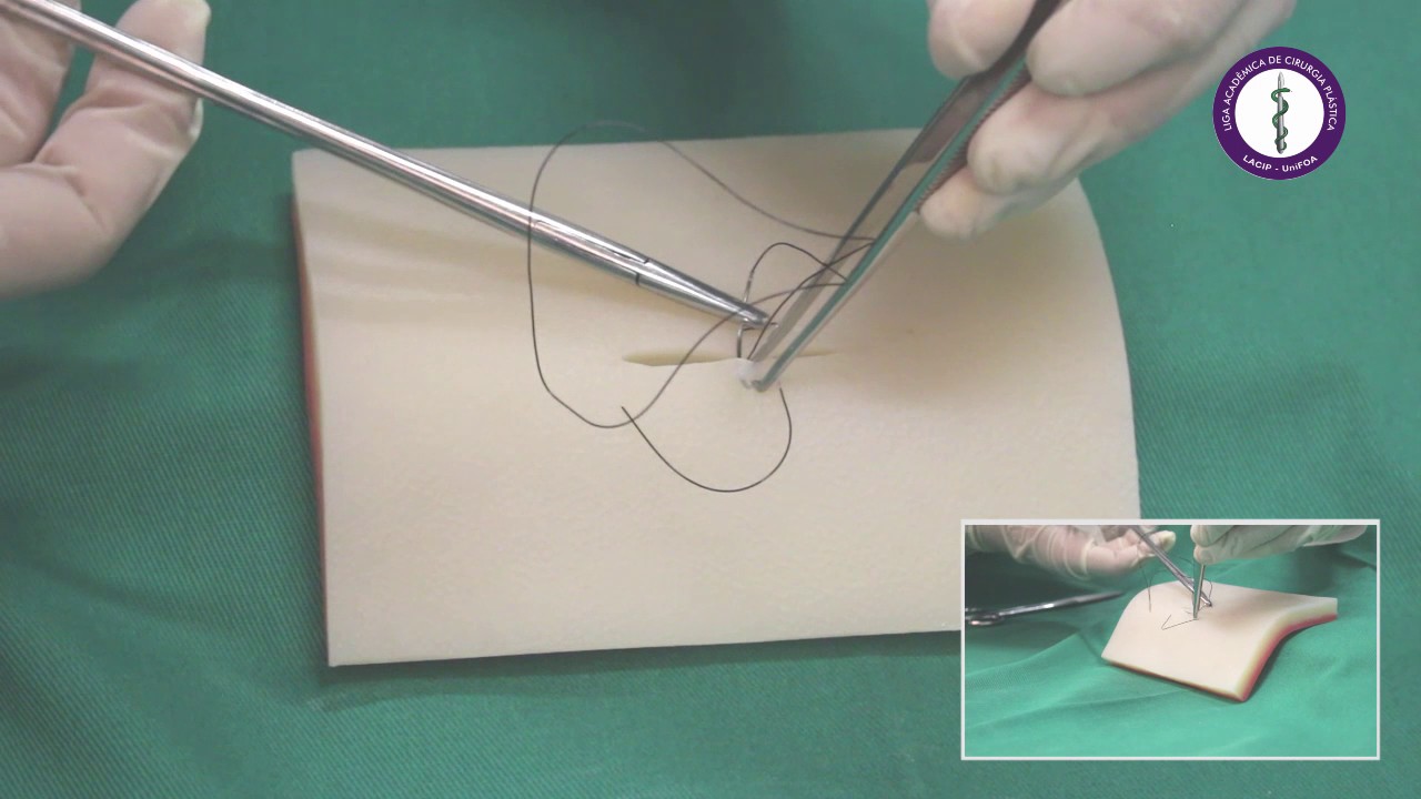 Sutura Horizontal em "U", de Wolff - YouTube