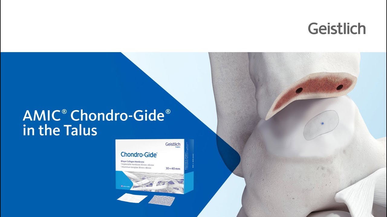 AMIC® Talus - Animation - YouTube