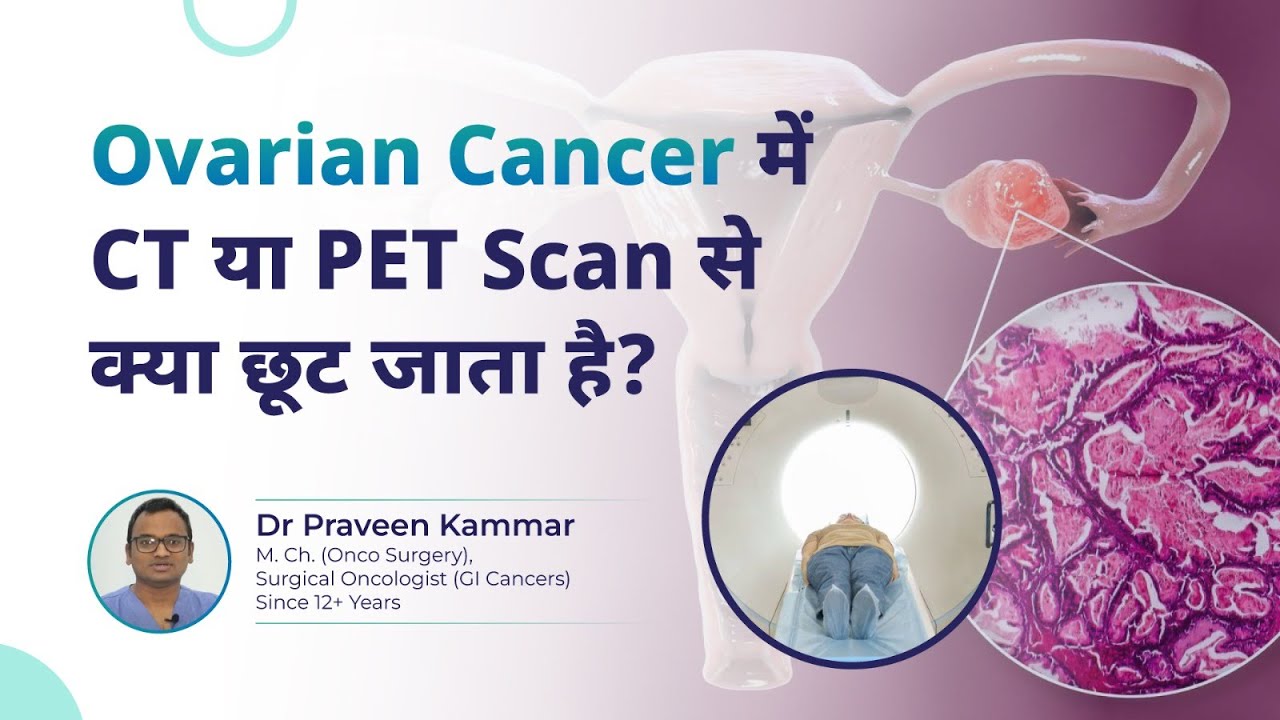 Ovarian Cancer में सिर्फ CT-PET Scan क्यों काफी नहीं? | Can CT Or PET ...