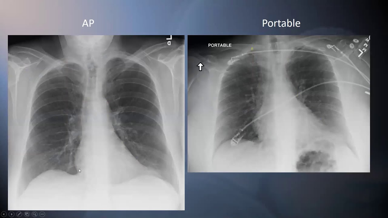 How to Read CXR - Dr. Jacob Mathew Jr. DO - YouTube