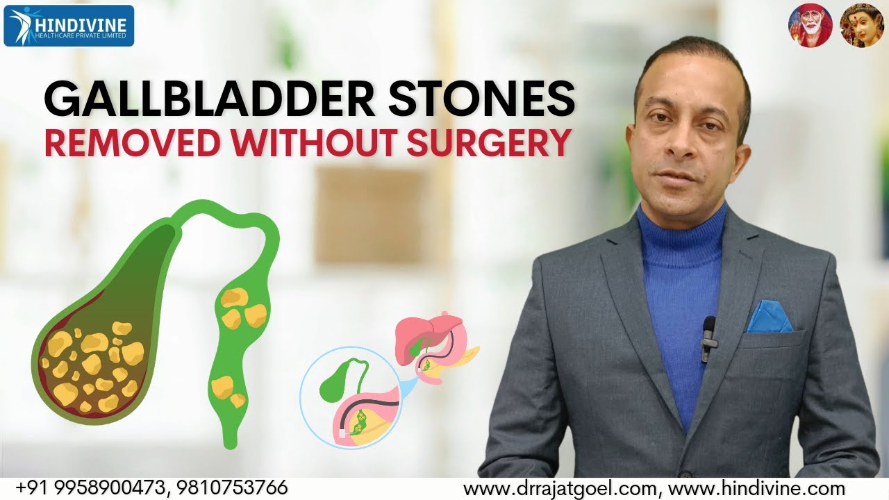 Can you remove Gall Bladder Stones without surgery ? | Gallstones ...