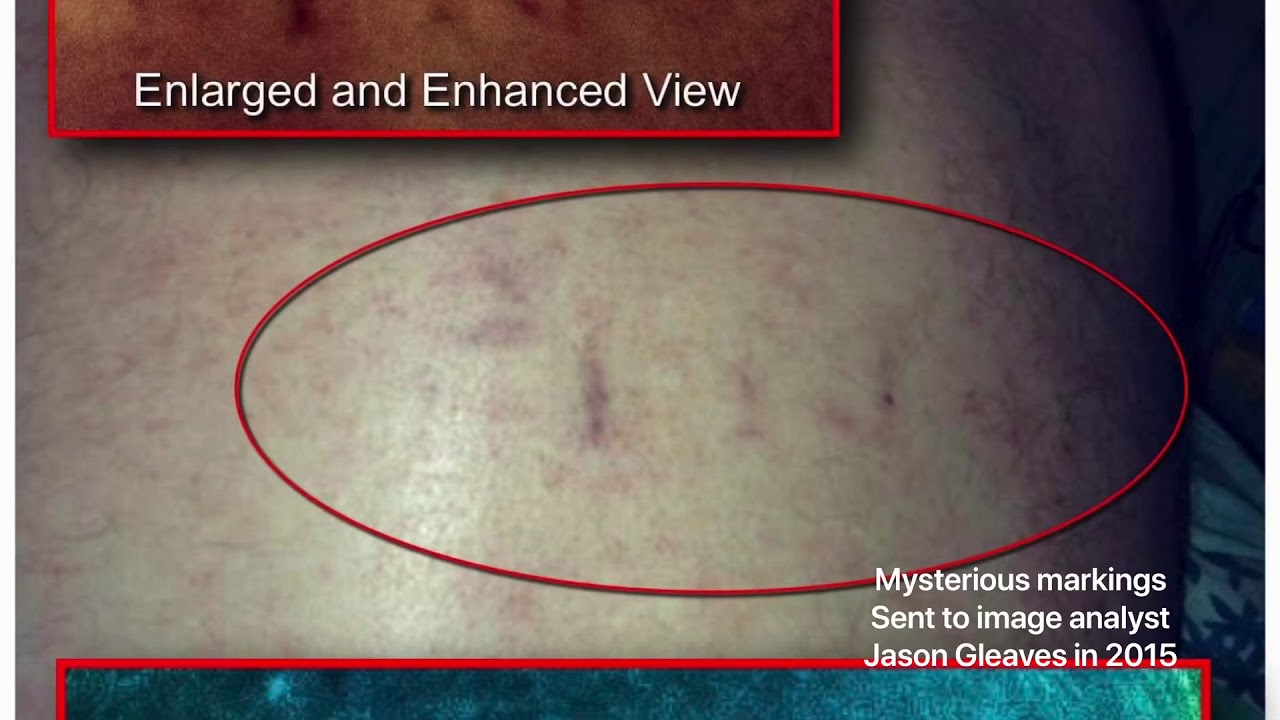 Strange markings on my back 2015 - YouTube