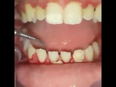 Full Mouth Debridement - YouTube