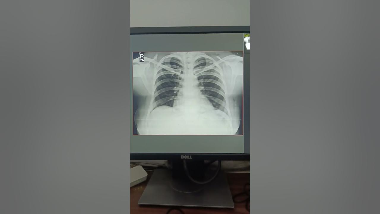 Xray bronchitis BVM are prominent both lung filde video like subscribe ...