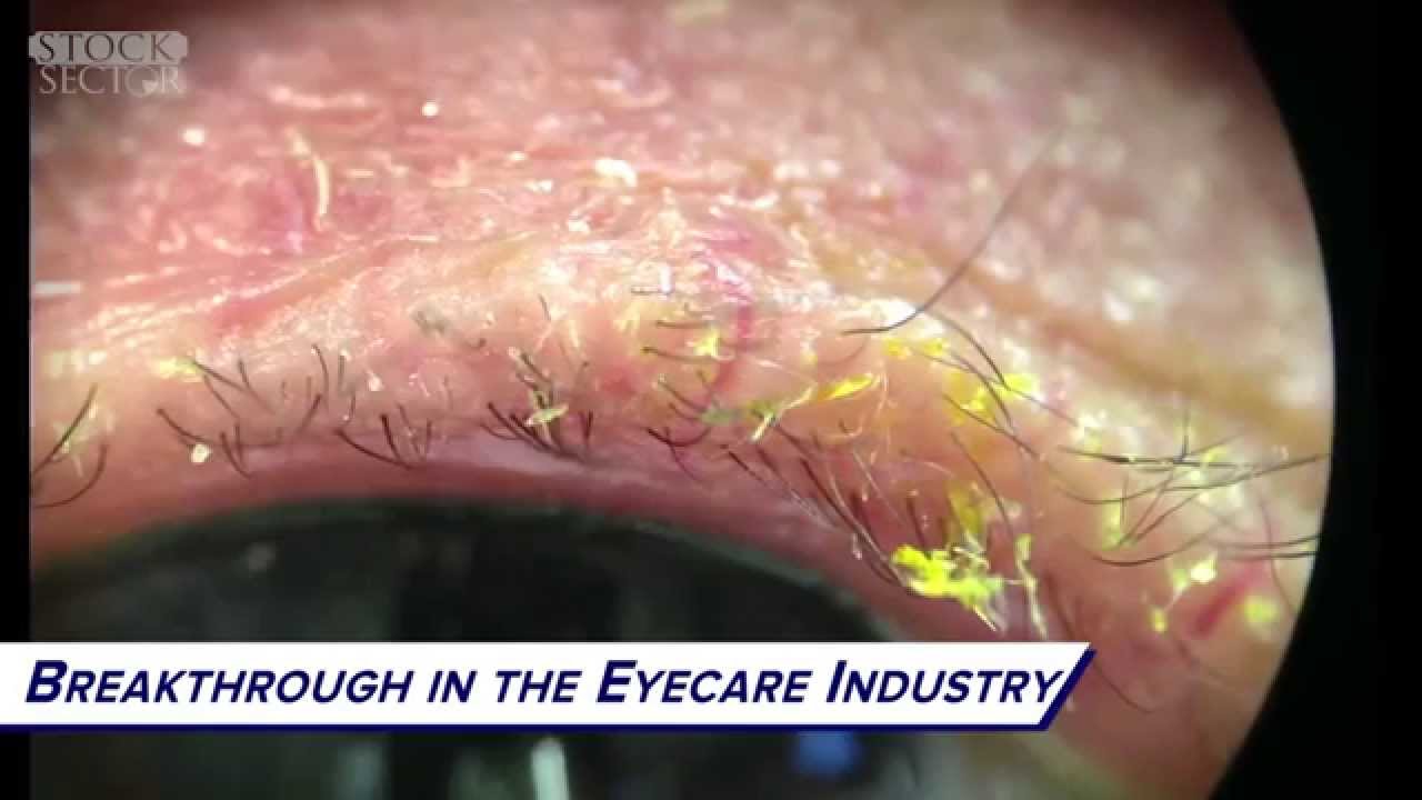 Breakthrough in Eye Care Industry - Avenova from Novabay (NYSE: NBY ...