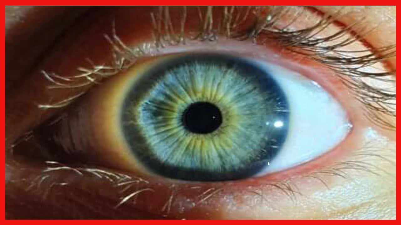 Causes des pupilles punctiformes ou myosis - YouTube