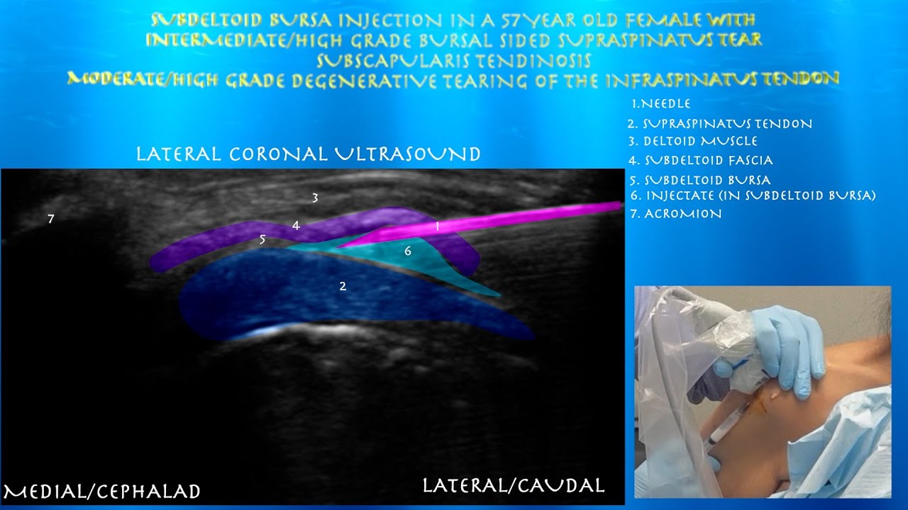 Ultrasound Guided Subdeltoid Bursa/Subacromial Injection in a 57 Year ...