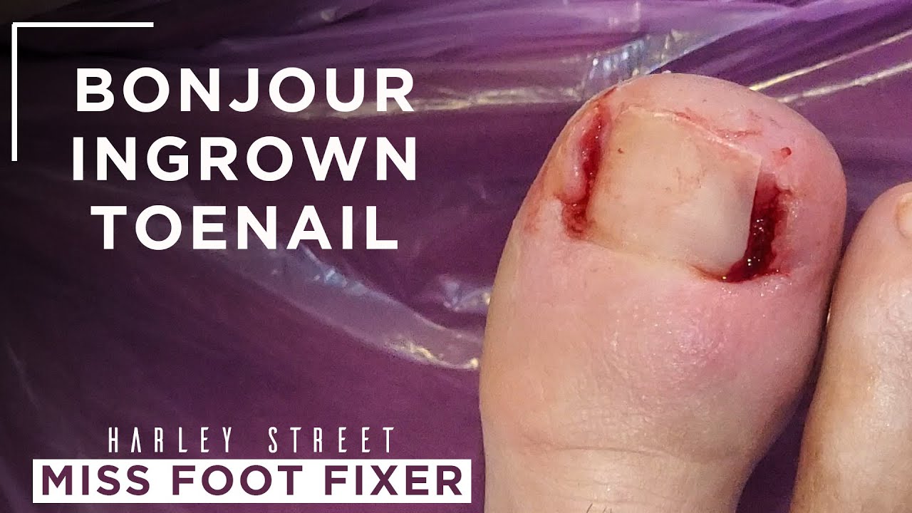 Ingrown toenails cutting By Miss Foot Fixer Marion Yau - YouTube