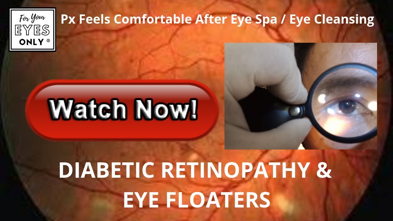 FYEO® - Diabetic Retinopathy & Eye Floaters FEELS RELAXED! - YouTube