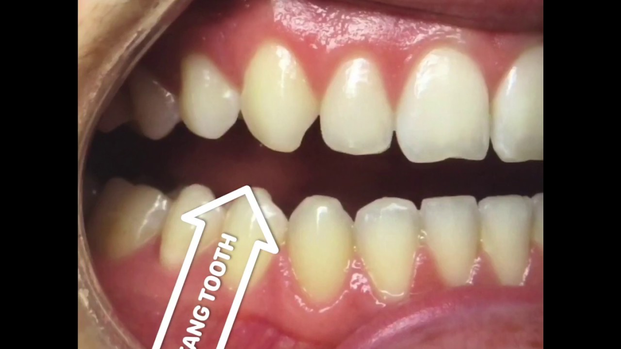 Using Bioclear and Uveneer along w/ the Warm Injection Molding Process ...