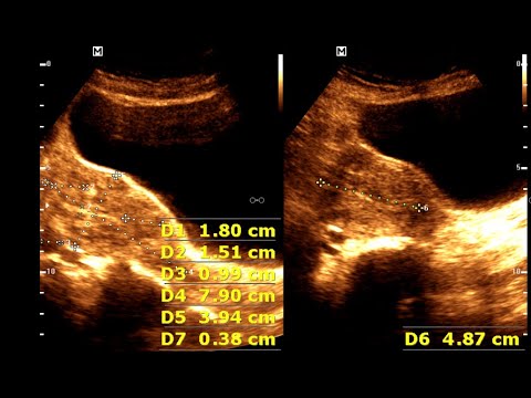 Multiple Fibroid Uterus | Leiomyoma of Uterus | Uterine Benign Tumor ...