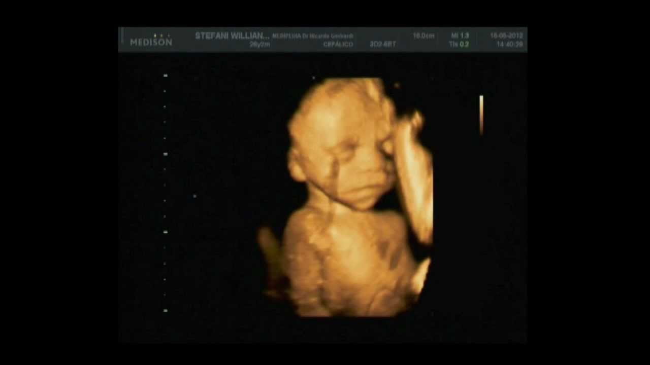 MEDIPEDIA Feto 7 meses 3D/4D em tempo real - YouTube