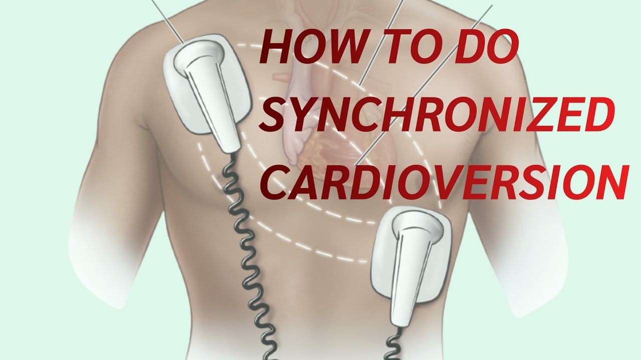 สาธิตวิธีการ Synchronized cardioversion เครื่อง Defibrillator ยี่ห้อ ...