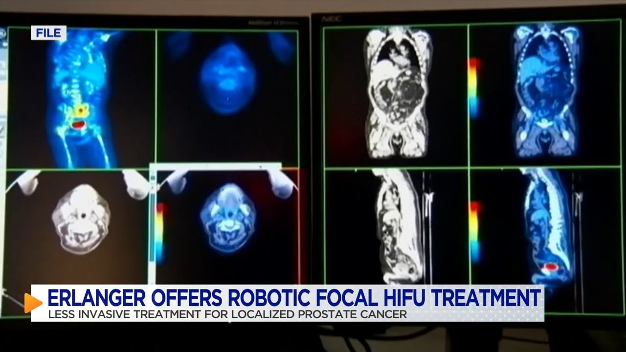 Erlanger offers advanced robotic HIFU treatment for prostate cancer ...