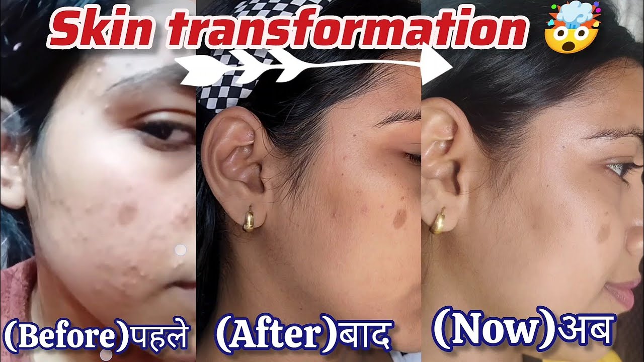 My Skin transformation journey 🤯 ️|Acne,Rough and Dry skin heal|Nishtha ...