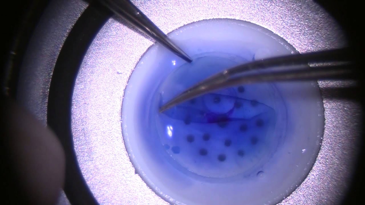 Full Thickness Trephination Management - YouTube