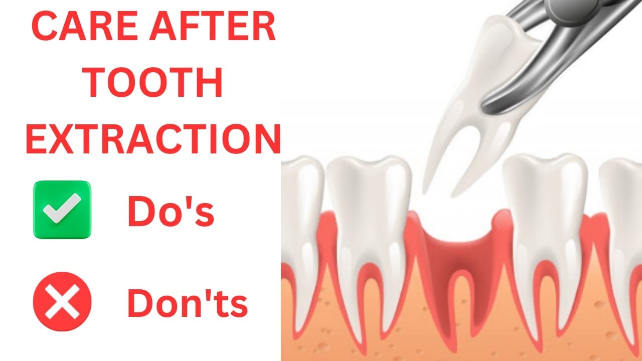 How to Care After Tooth Extraction: Essential Recovery Tips - YouTube
