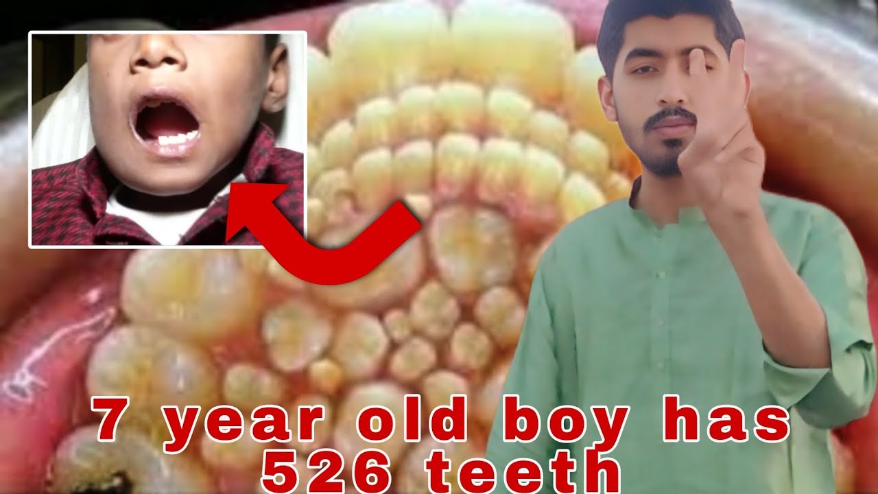 7 year old boy has 526 teeth - YouTube