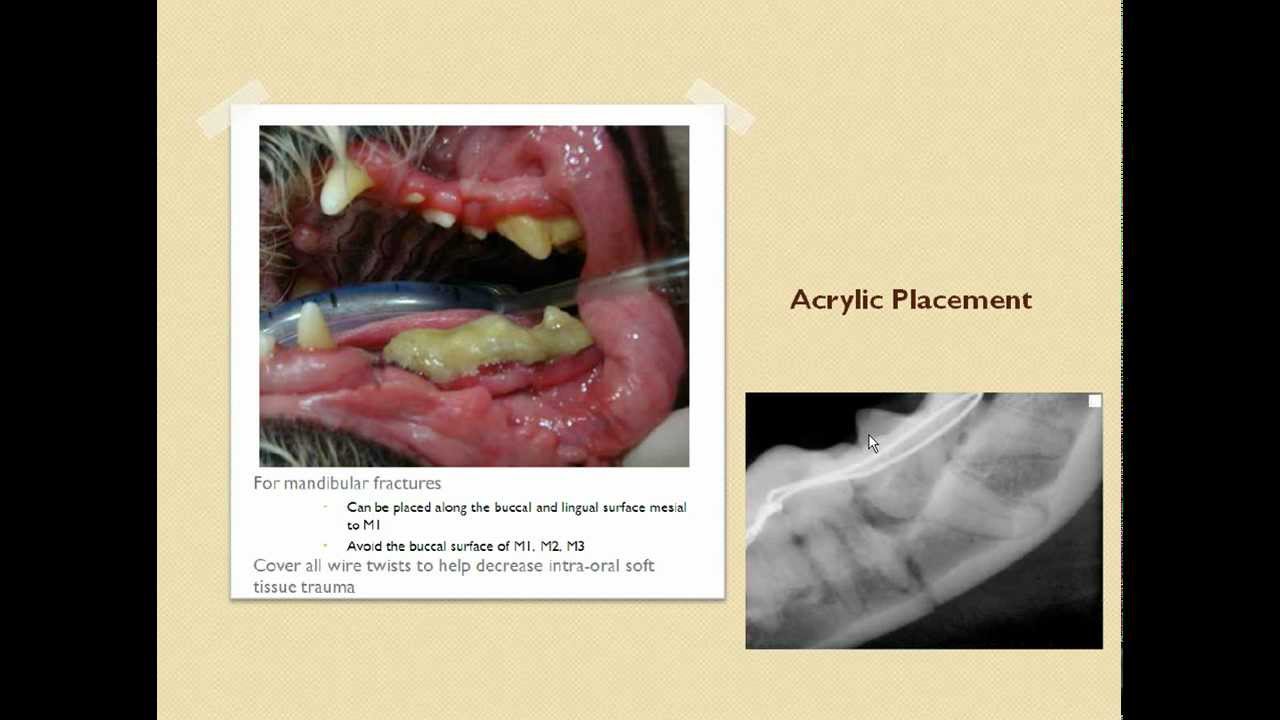 Non-Invasive Mandibular Fracture Repair - YouTube