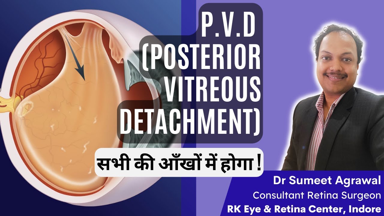 PVD (Posterior Vitreous Detachment). Retina का यह change सभी की आँखों ...
