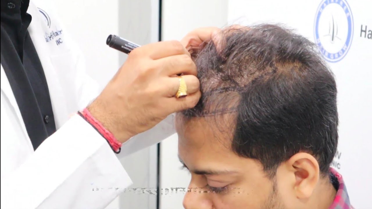 Planing of hair transplant for DUPA Pattern Baldness | Best Hair ...