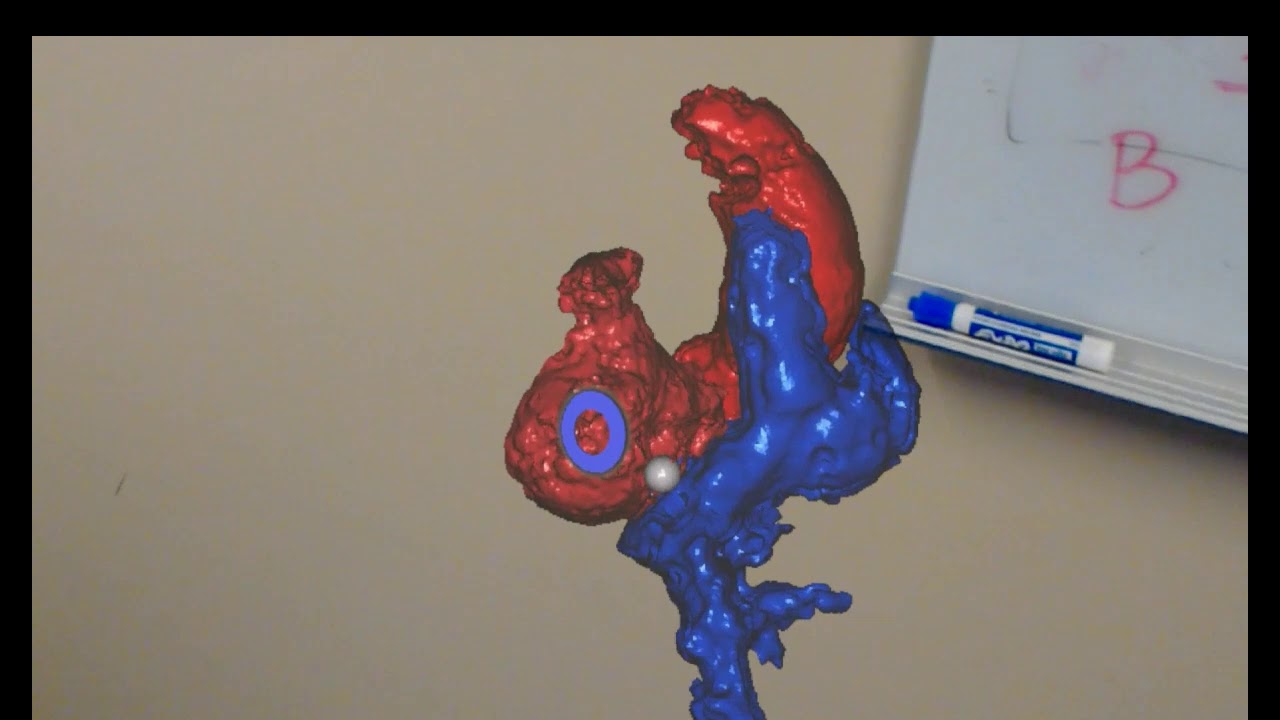 Left Atrial Appendage Model in Augmented Reality - YouTube