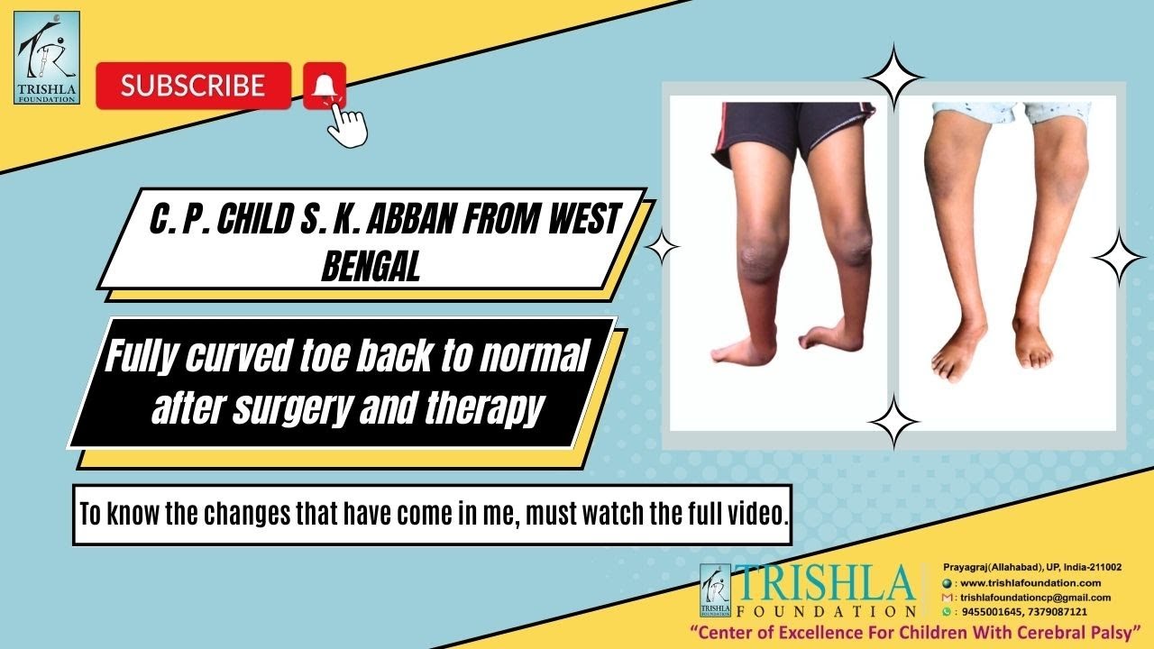 Cerebral Palsy: Overcoming Foot Deformity with Courage - YouTube