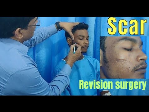 scar revision surgery| A Big scar on cheek- Treatment by scar revision ...