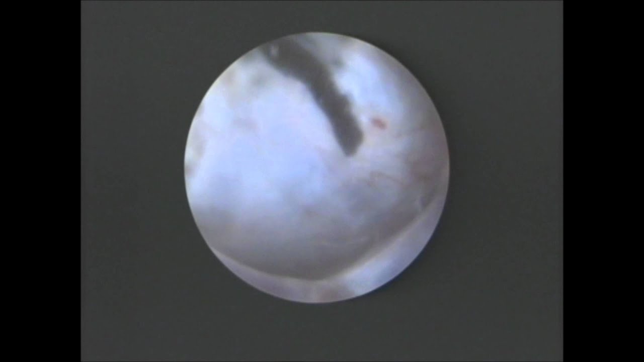 Endoscopic third ventricle arachnoid cyst fenestration and ETV - YouTube