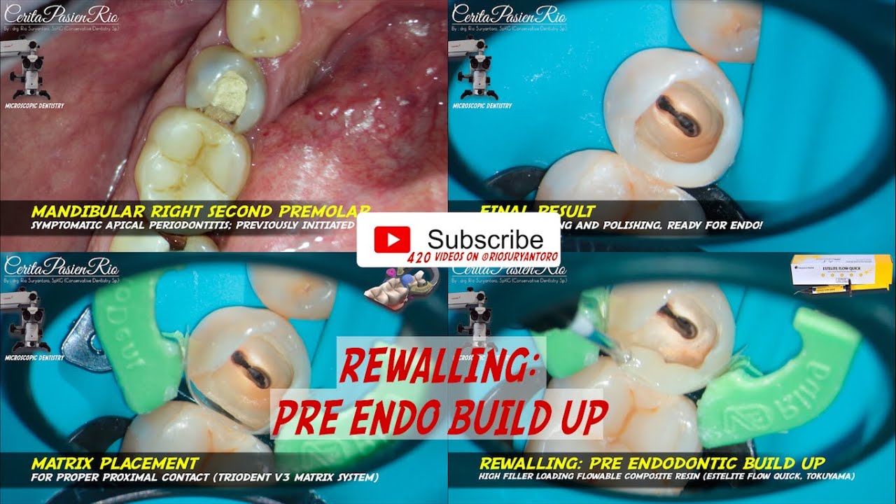 rewalling pre endodontic build up ESTELITE FLOW QUICK tokuyama triodent ...