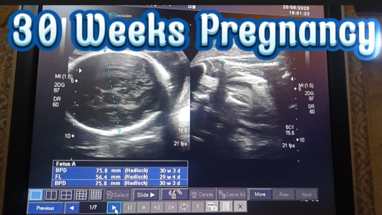 Case # 13: 30 Weeks Pregnancy Scan | Anterior Placenta & Baby Boy - YouTube