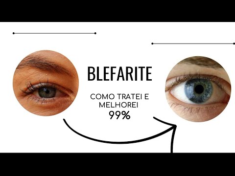 Blefarite como tratar? - YouTube