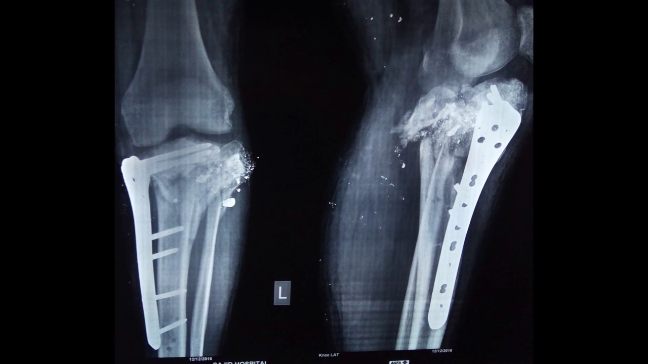 fix the fracture with a locking plate as a external fixator . by ...
