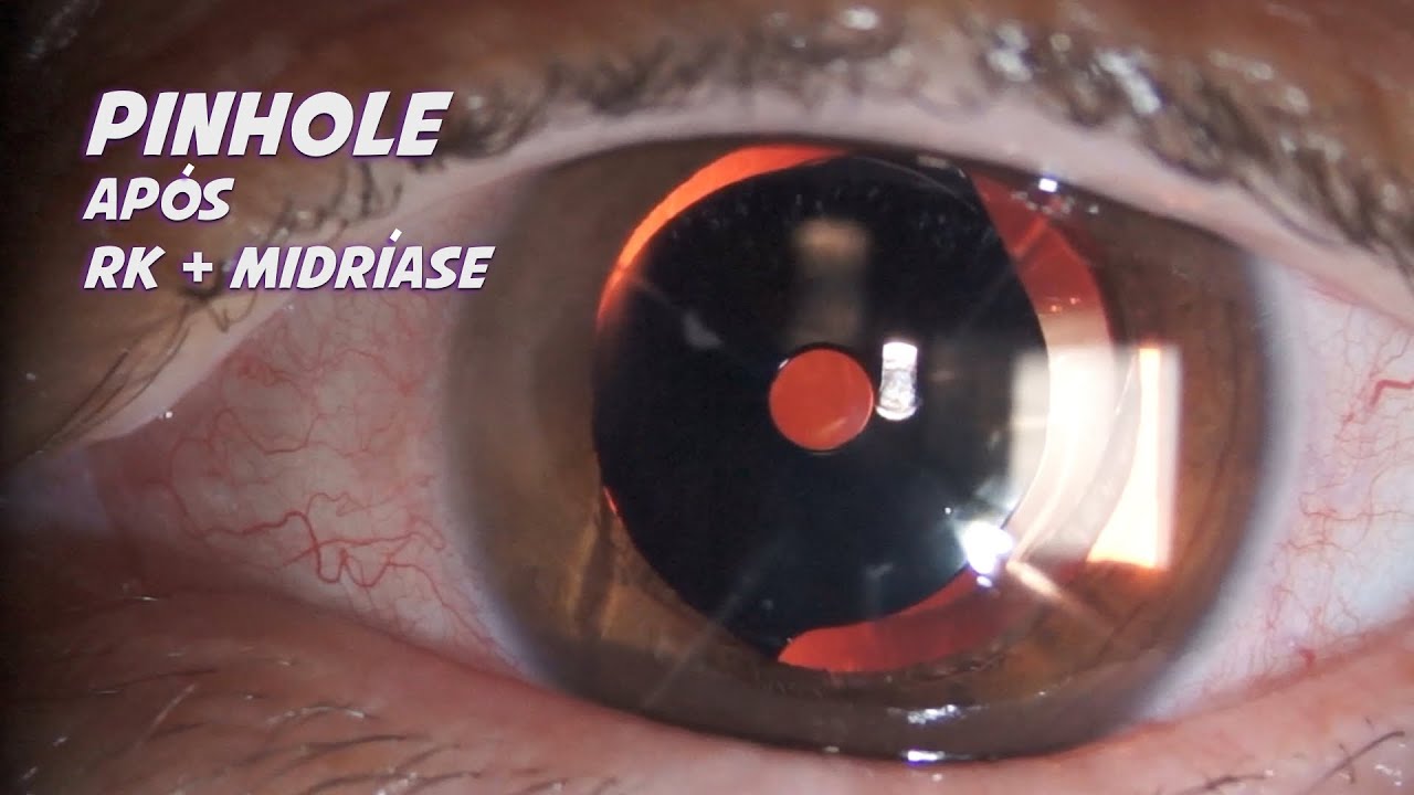 Implante estenopeico XtraFocus após RK (ceratotomia radial) - YouTube