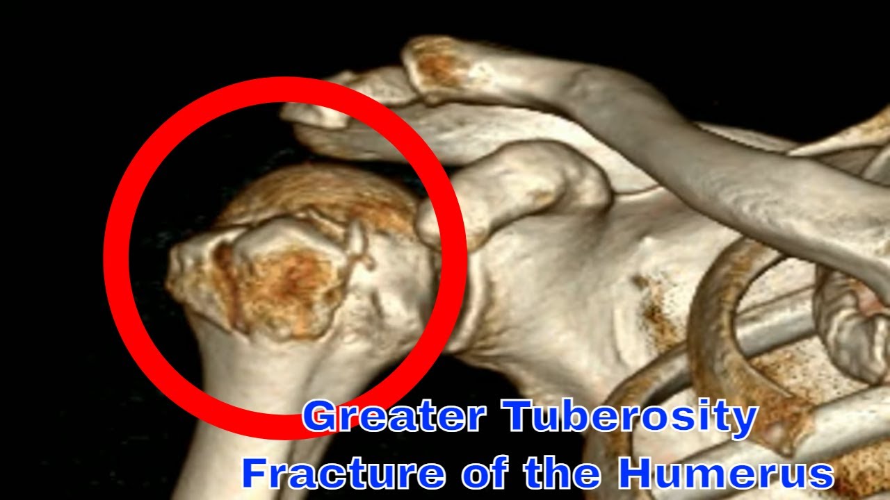 Greater Tuberosity fracture of the Humerus 상완골 대결절 골절 - YouTube