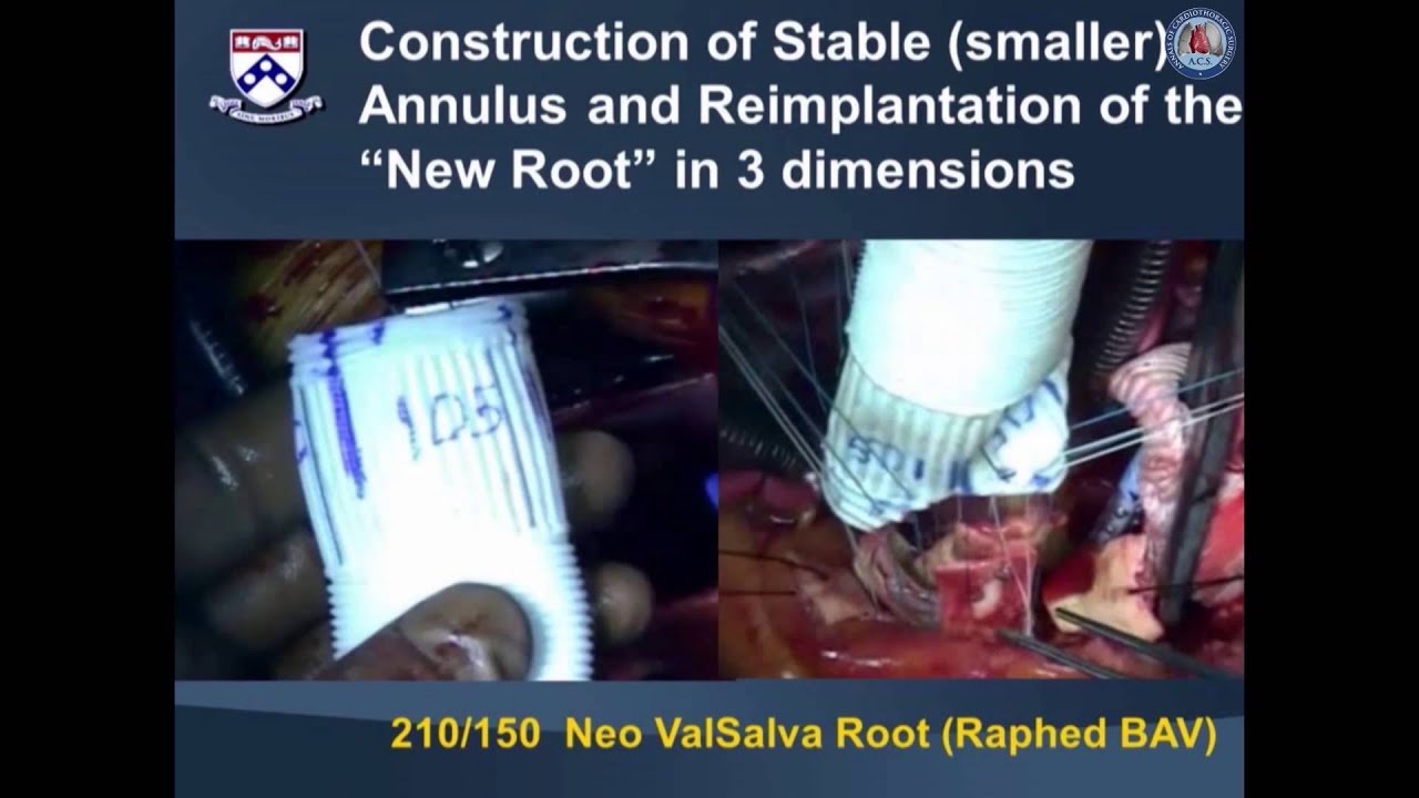 Valve-sparing aortic root reimplantation and cusp repair in bicuspid ...