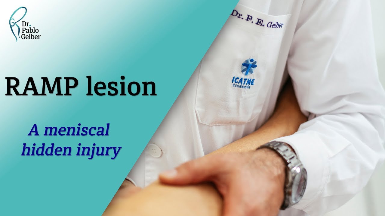 Ramp Lesion o lesiones de la Rampa meniscal - YouTube