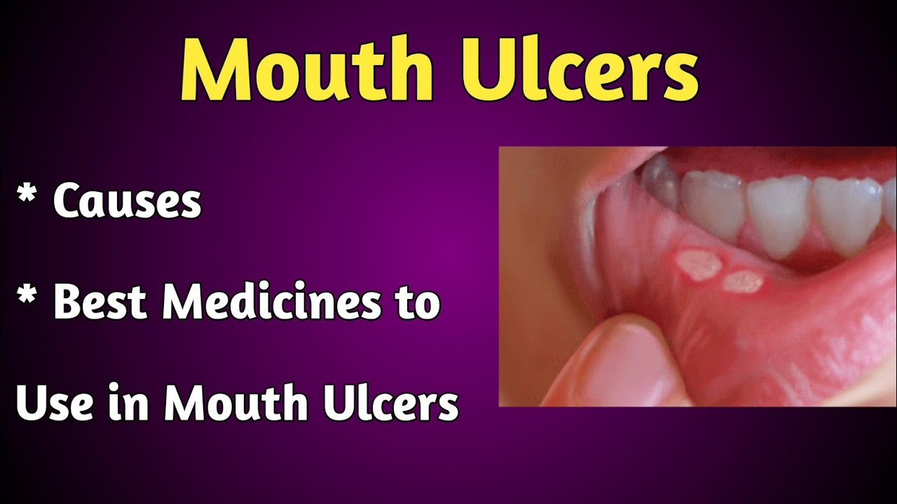 Mouth Ulcers Causes and Treatment. - YouTube