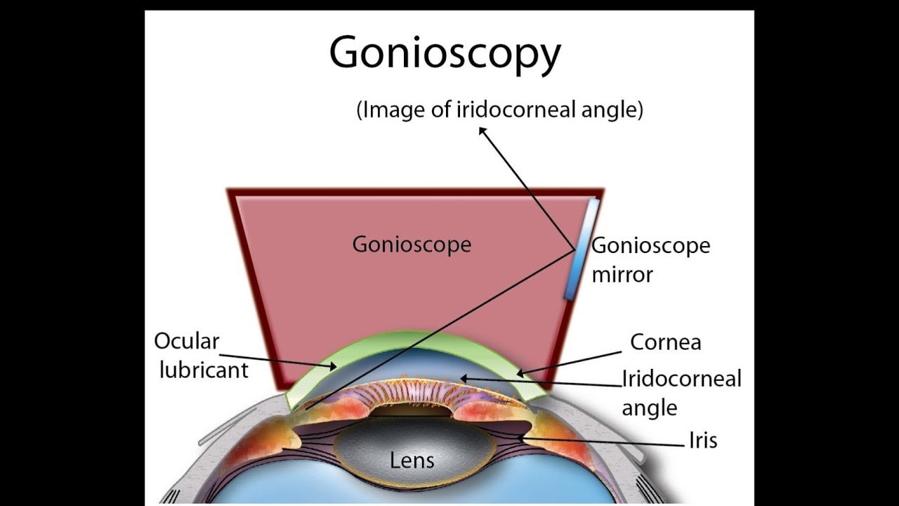 Gonioscopy procedure to evaluate the anterior chamber angle of the eye ; Application, Importance ...