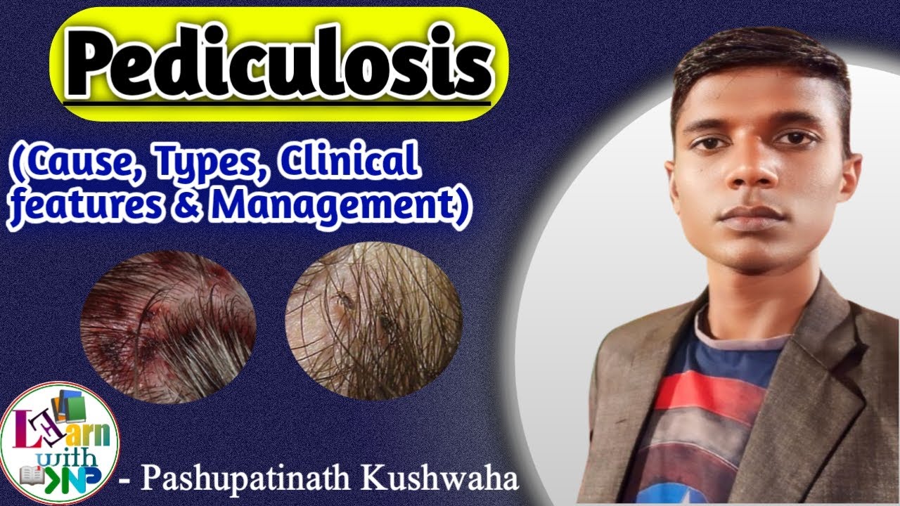 Pediculosis | Treatment of pediculosis | Louse | Lice infestation ...