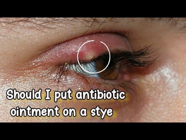 Are Dog Styes Contagious To Humans